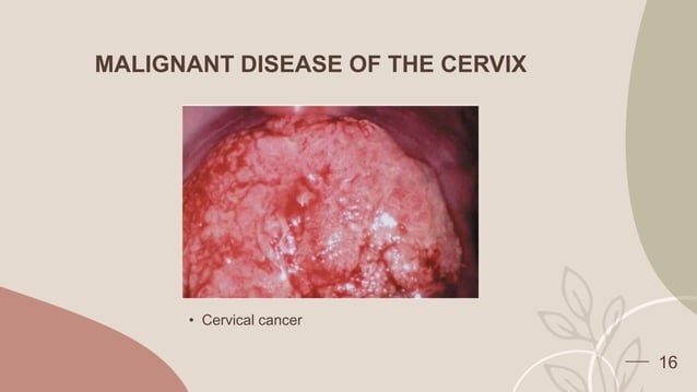 PREMALIGNANT AND MALIGNANT DISEASE OF CERVIX (1).pptx