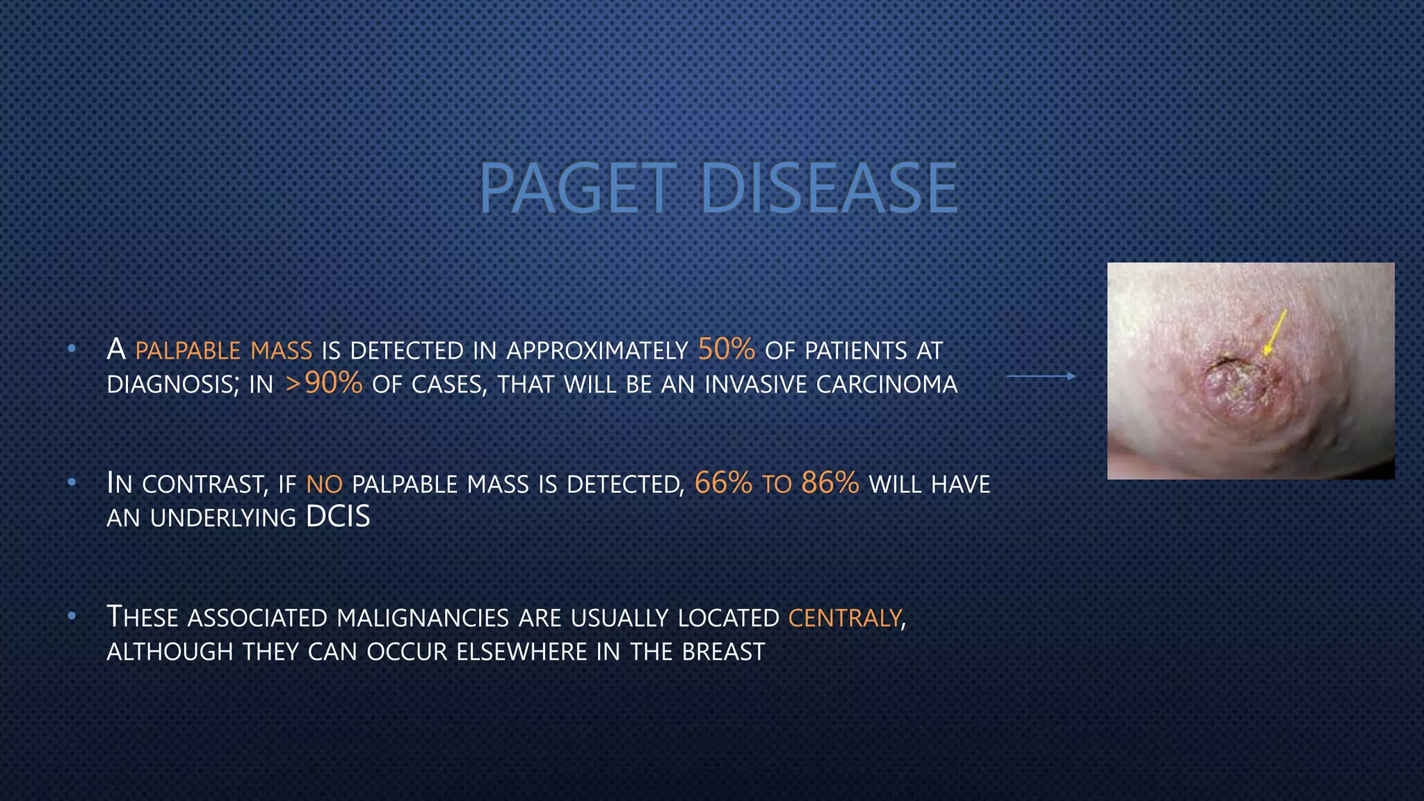 Premalignant conditions in Breast.pptx