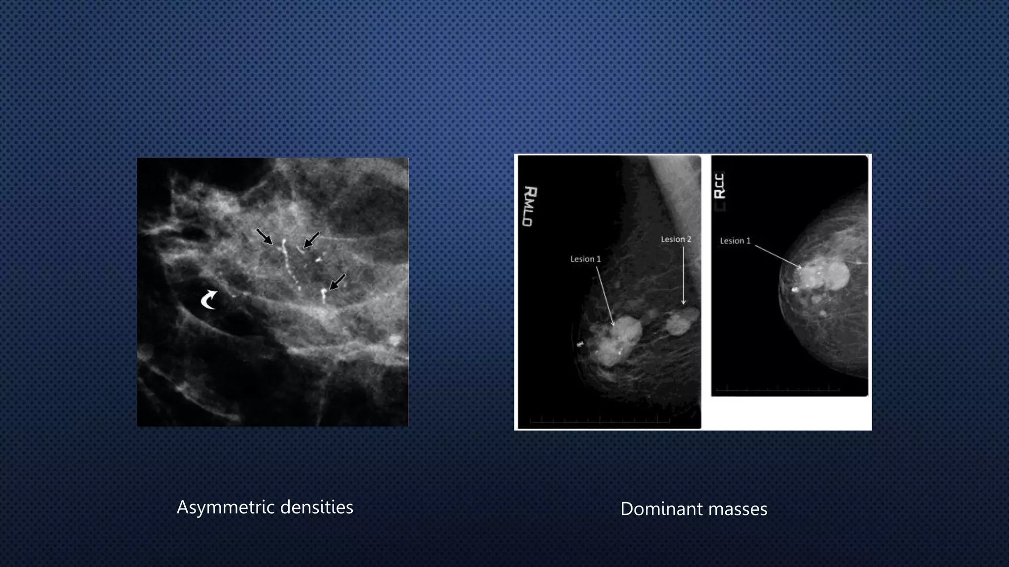 Premalignant conditions in Breast.pptx