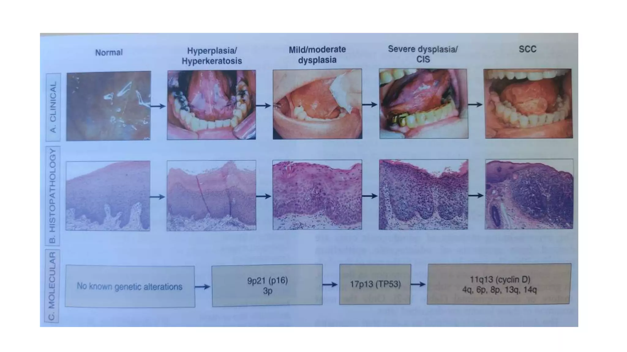 Premalignant conditions of oral cavity | PPTX