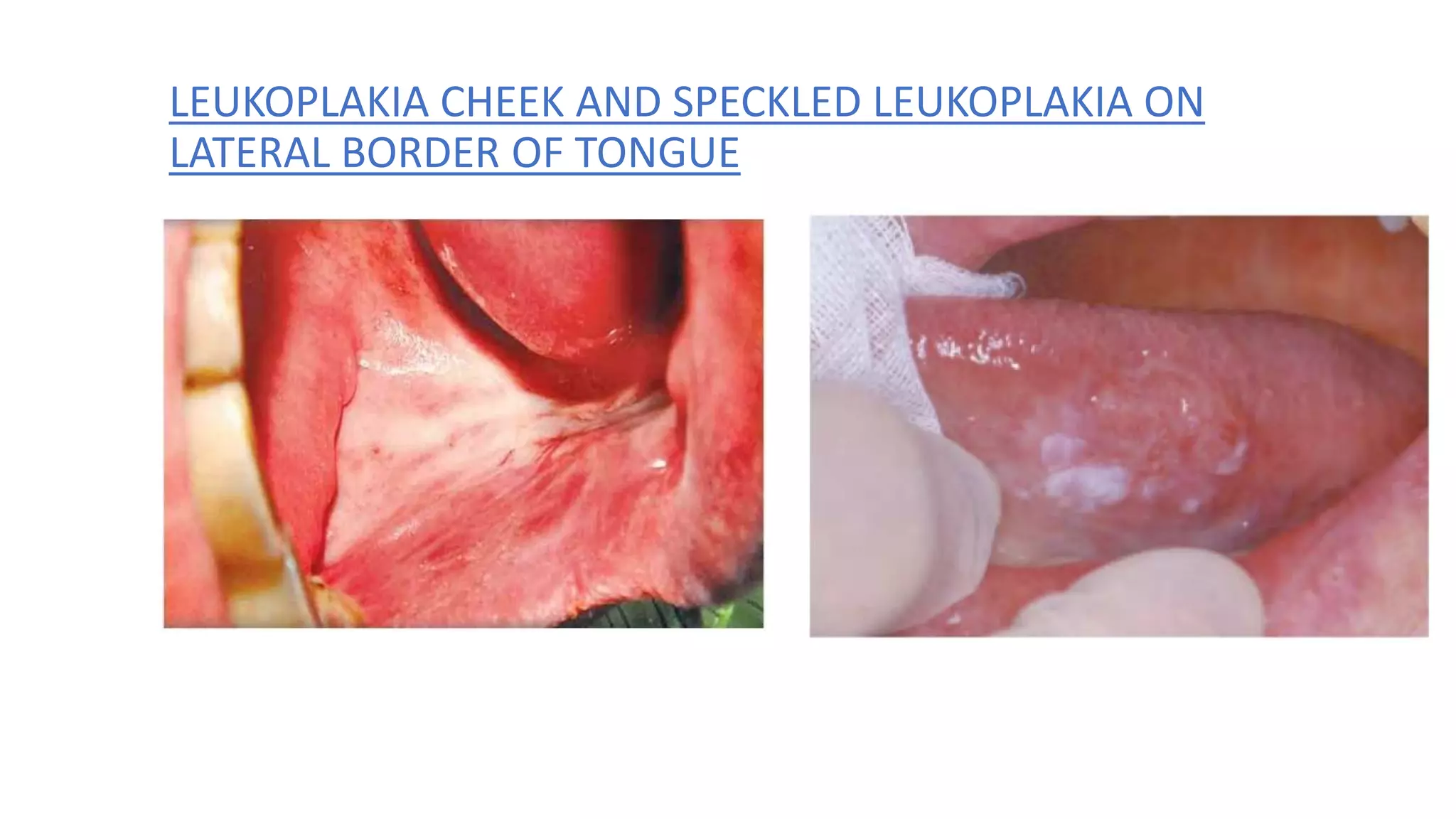 Premalignant conditions of oral cavity | PPTX