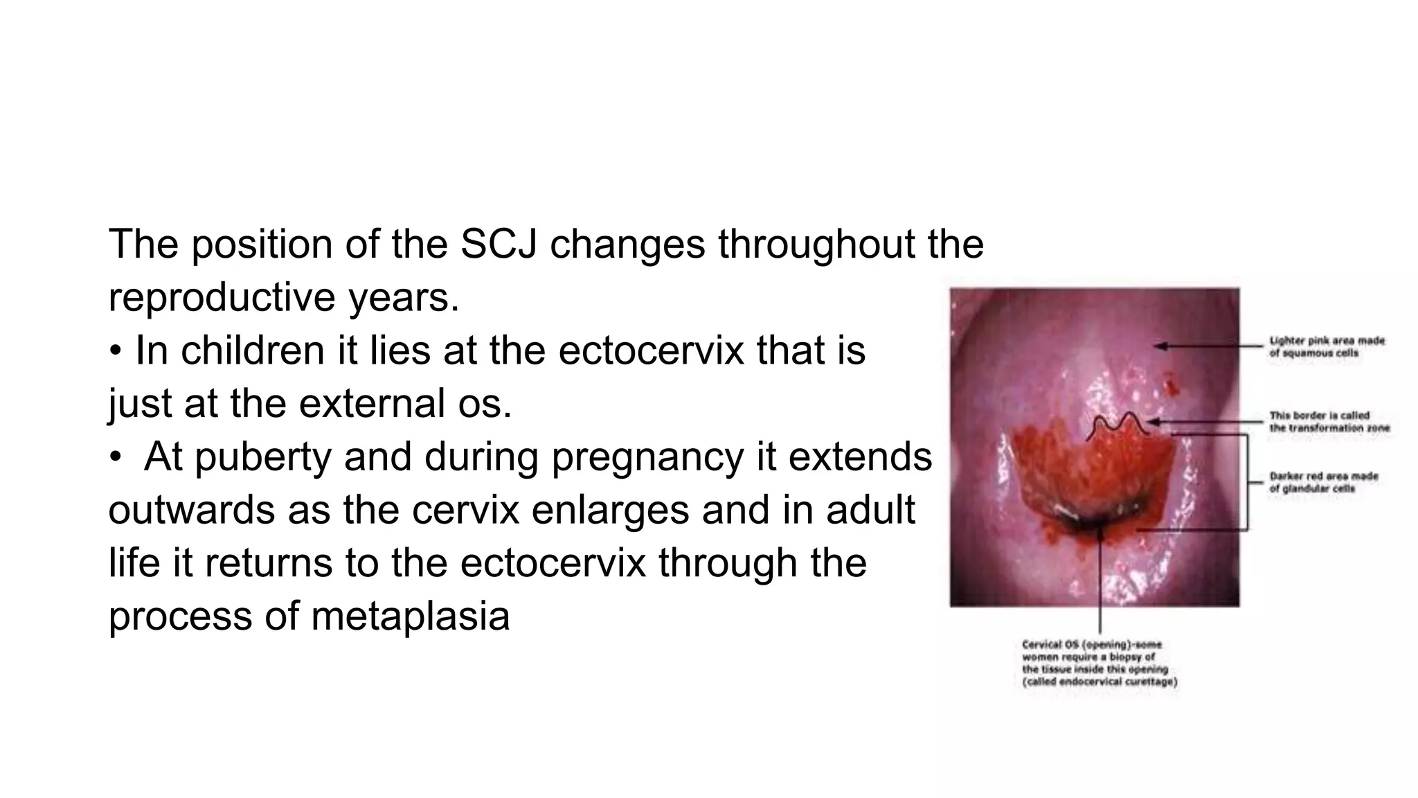 Premalignant diseases of the cervix | PPTX