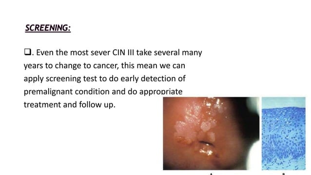 Premalignant Diseases Of The Cervix