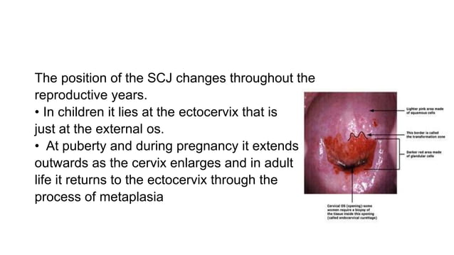 Premalignant Diseases Of The Cervix