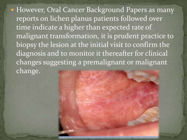 Premalignant lesion (Doctor Faris Alabeedi MSc, MMedSc, PgDip, BDS ...