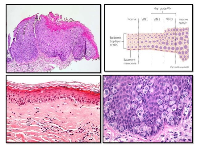 Premalignant lesion of vulva | PPTX | Skin and Dermatology | Diseases ...