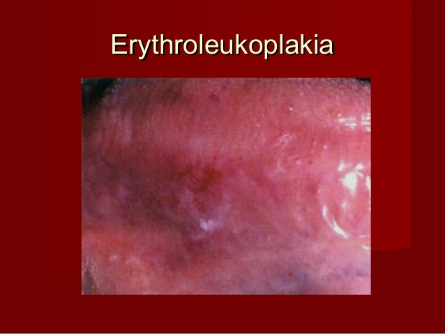 Premalignant lesions