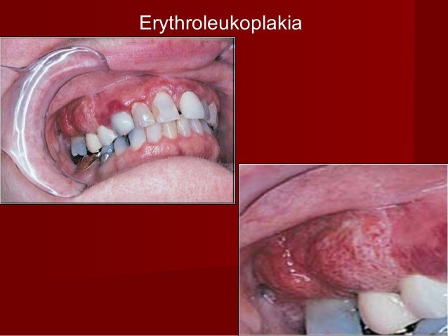 Erythroleukoplakia Gums