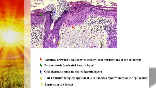 Premalignant Skin Conditions | PPTX