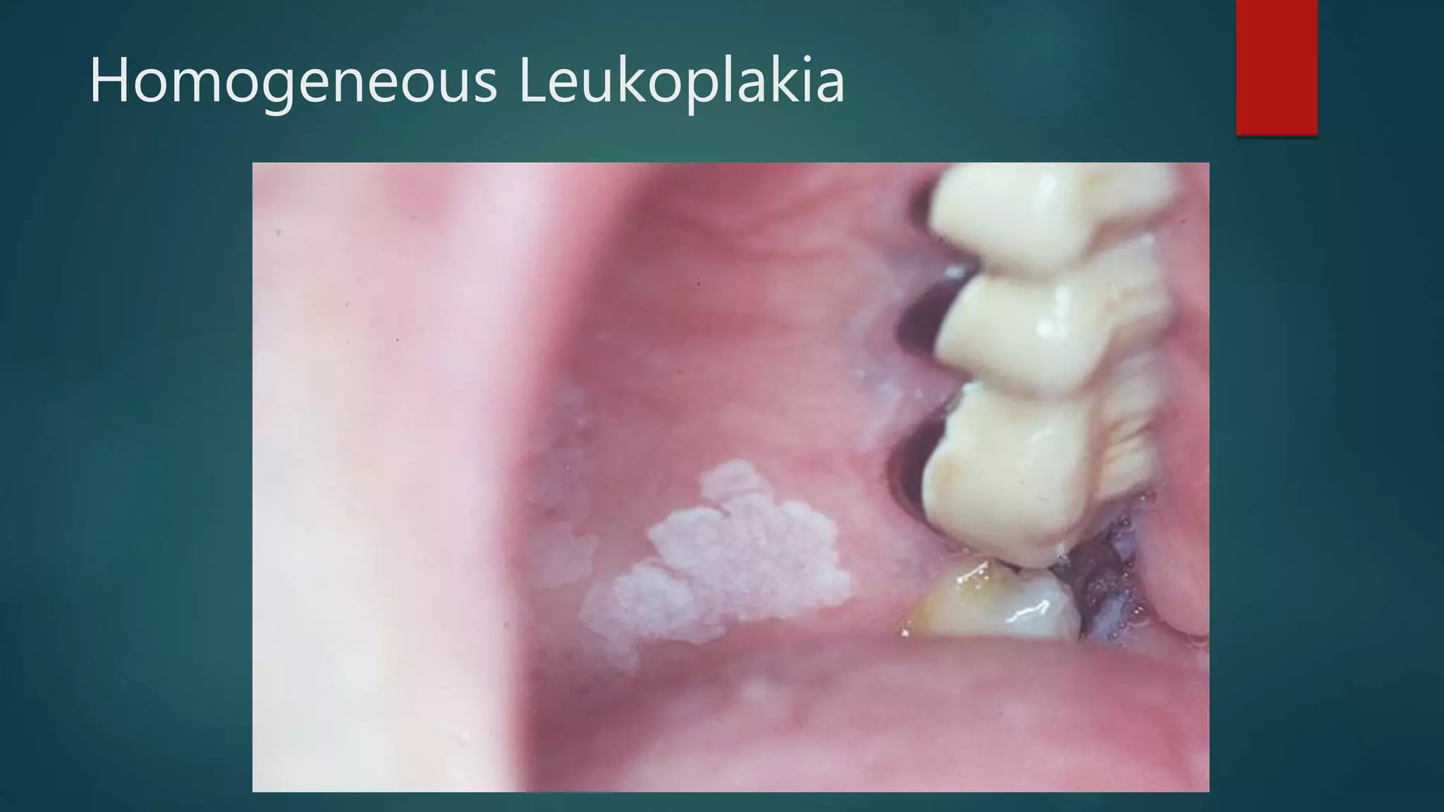 Premalignant lesions and biopsy | PPTX