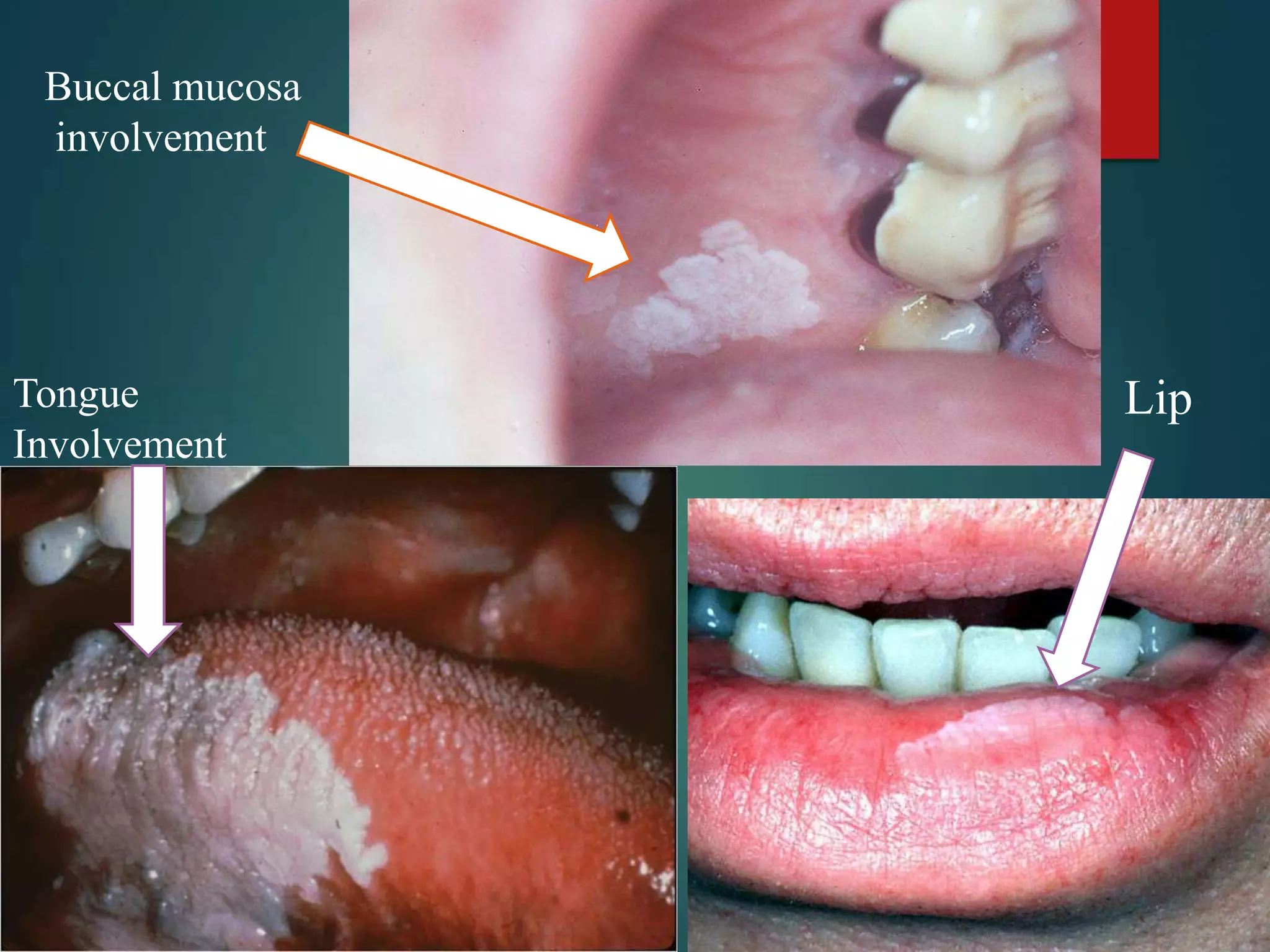 Premalignant lesions and conditions | PPTX