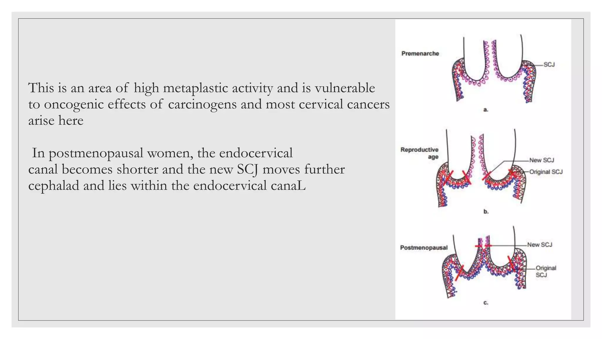 premalignant lesions of cervix.pptx