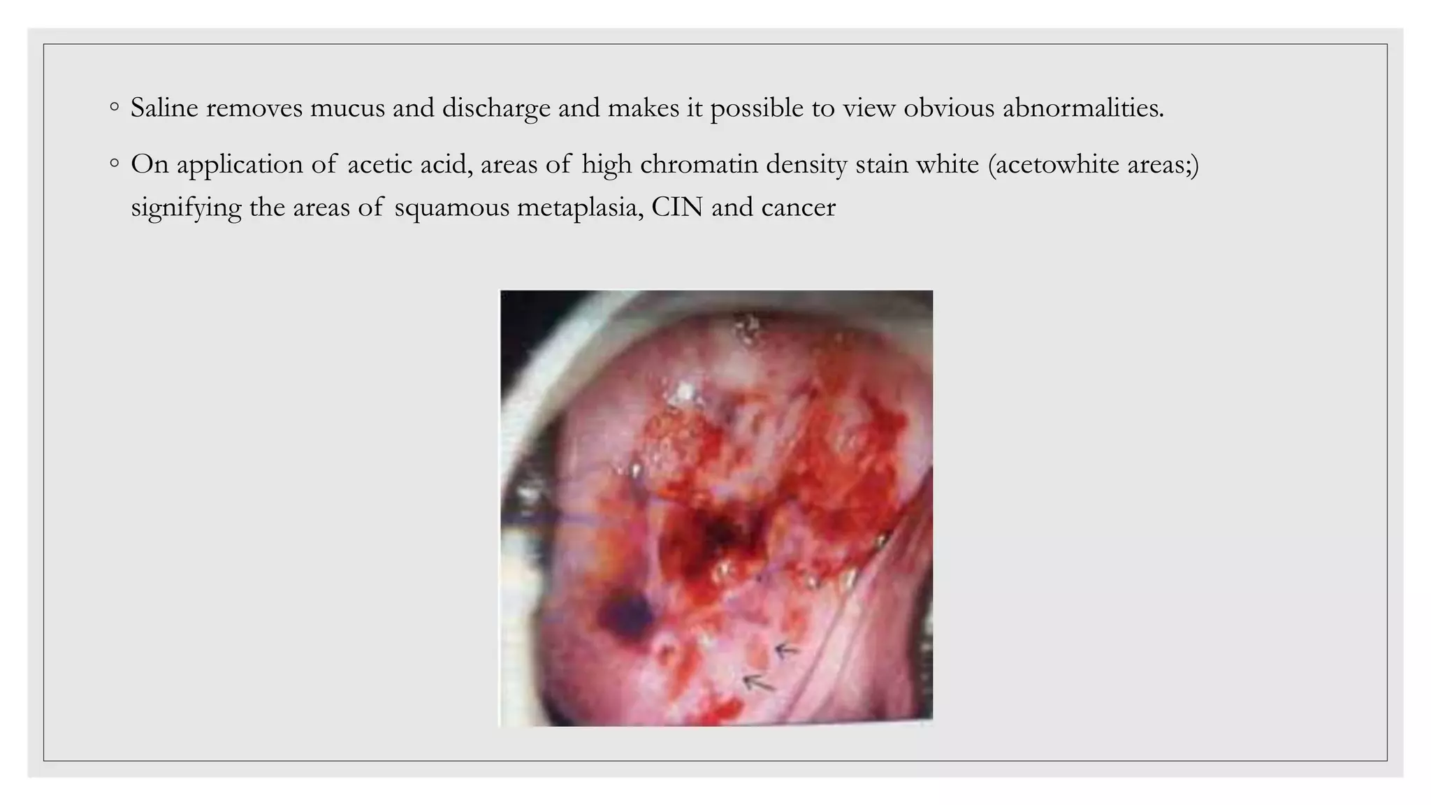 premalignant lesions of cervix.pptx