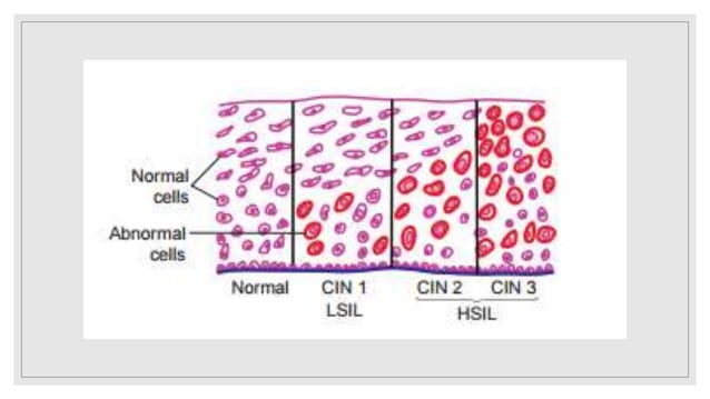 premalignant lesions of cervix.pptx