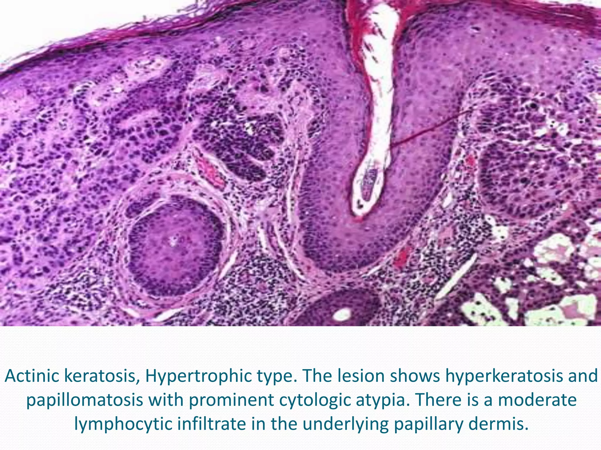 Pre malignant lesions of skin | PPTX