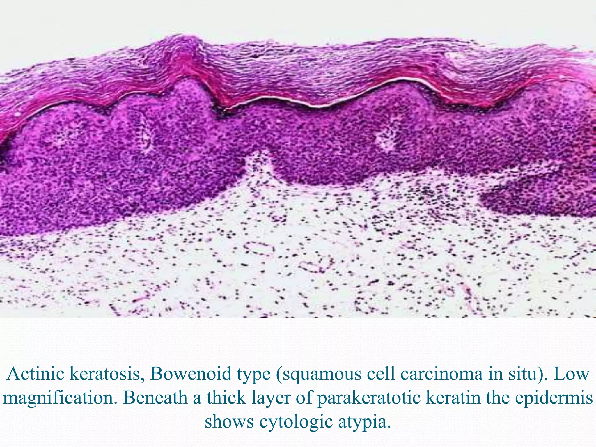 Pre malignant lesions of skin | PPTX