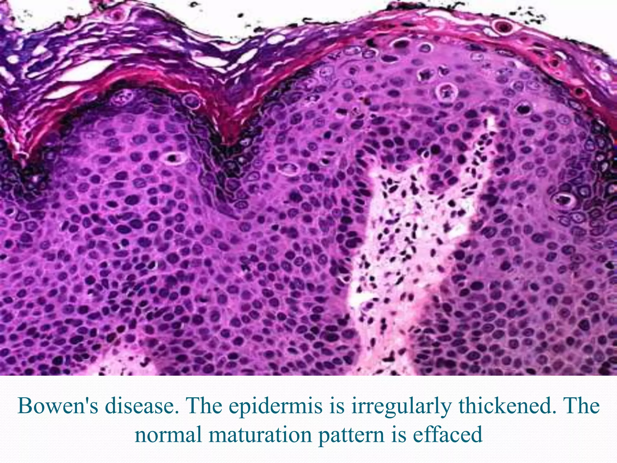 Pre malignant lesions of skin | PPTX