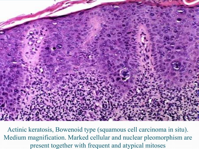 Pre malignant lesions of skin | PPTX