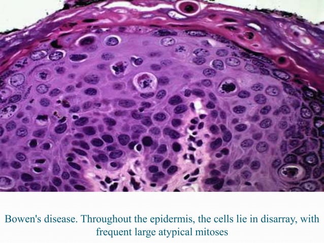 Pre malignant lesions of skin | PPTX