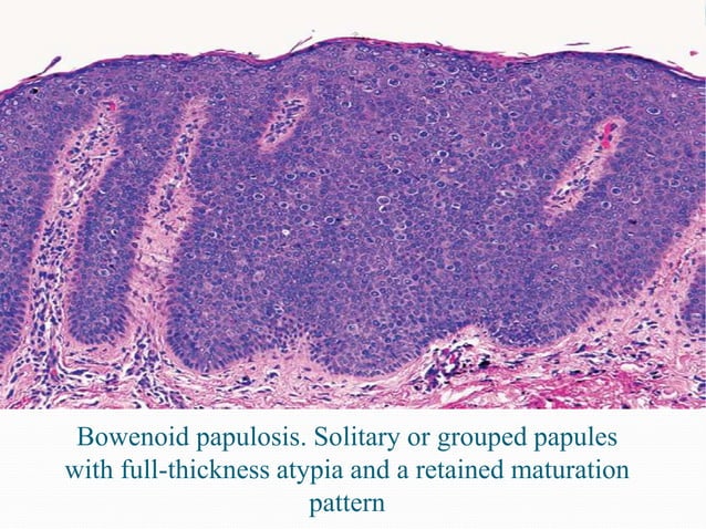 Pre malignant lesions of skin | PPTX