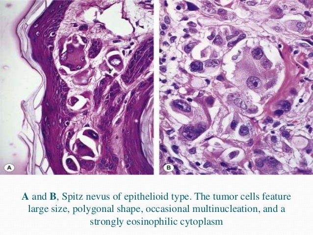 Pdt Precancerous Lesions