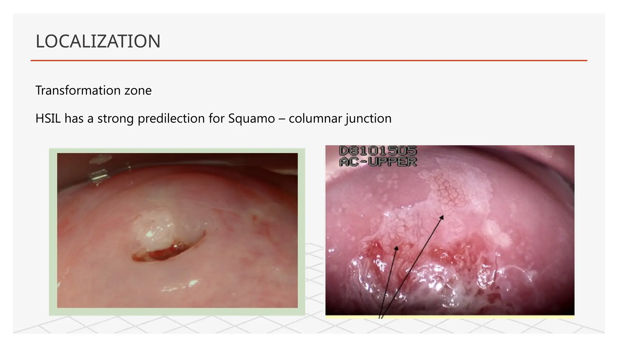 PREMALIGNANT LESIONS OF THE UTERINE CERVIX PPT.pptx