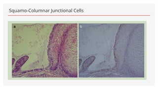 PREMALIGNANT LESIONS OF THE UTERINE CERVIX PPT.pptx