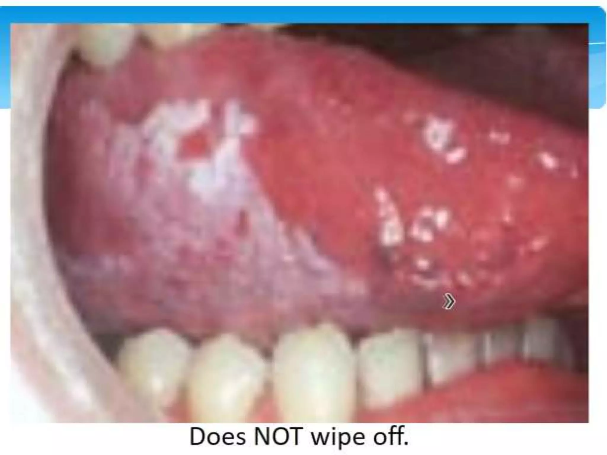 Premalignant & malignant diseases of oral cavity ii n | PPTX