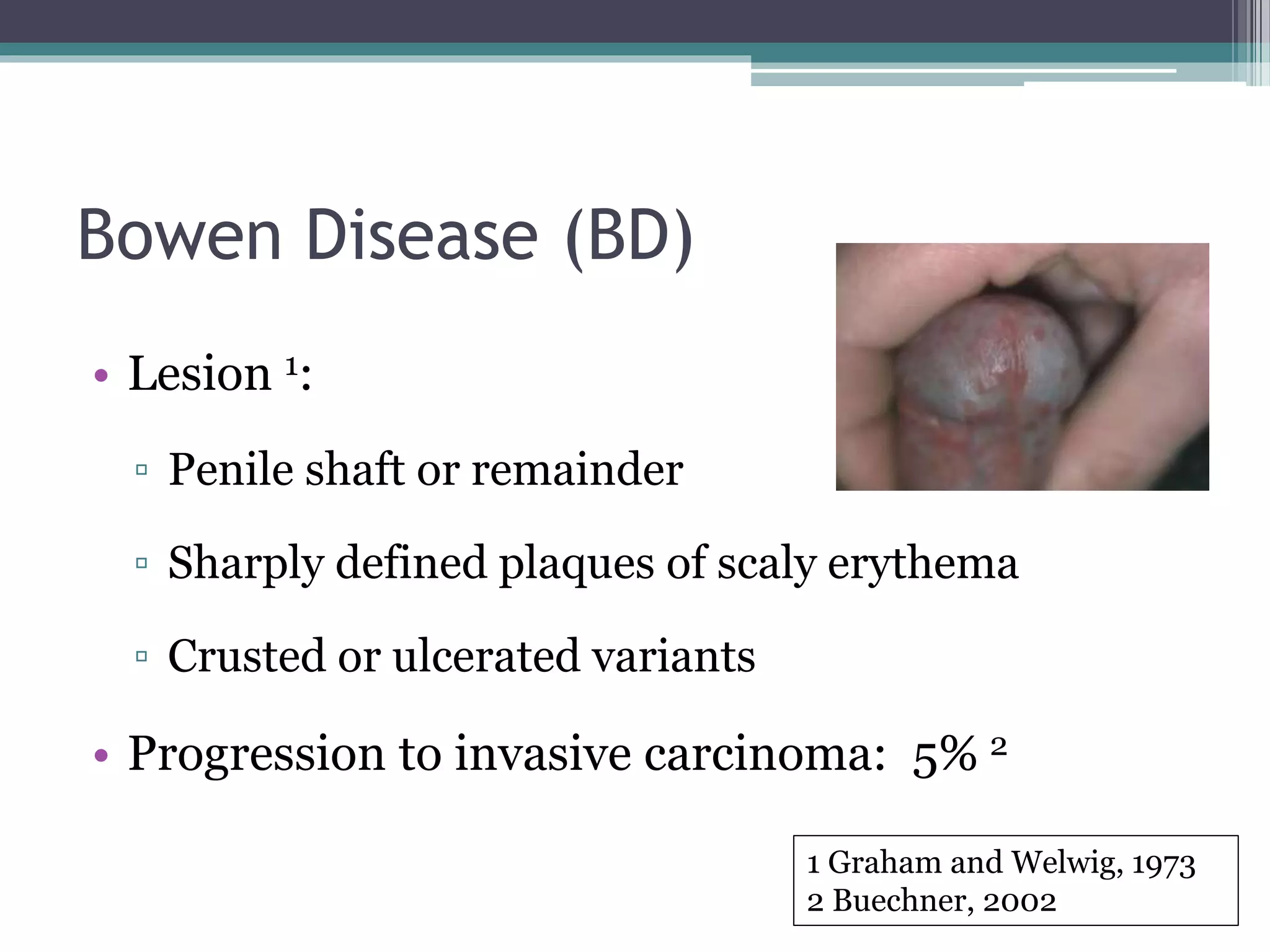 Premalignant penile lesions.pptx