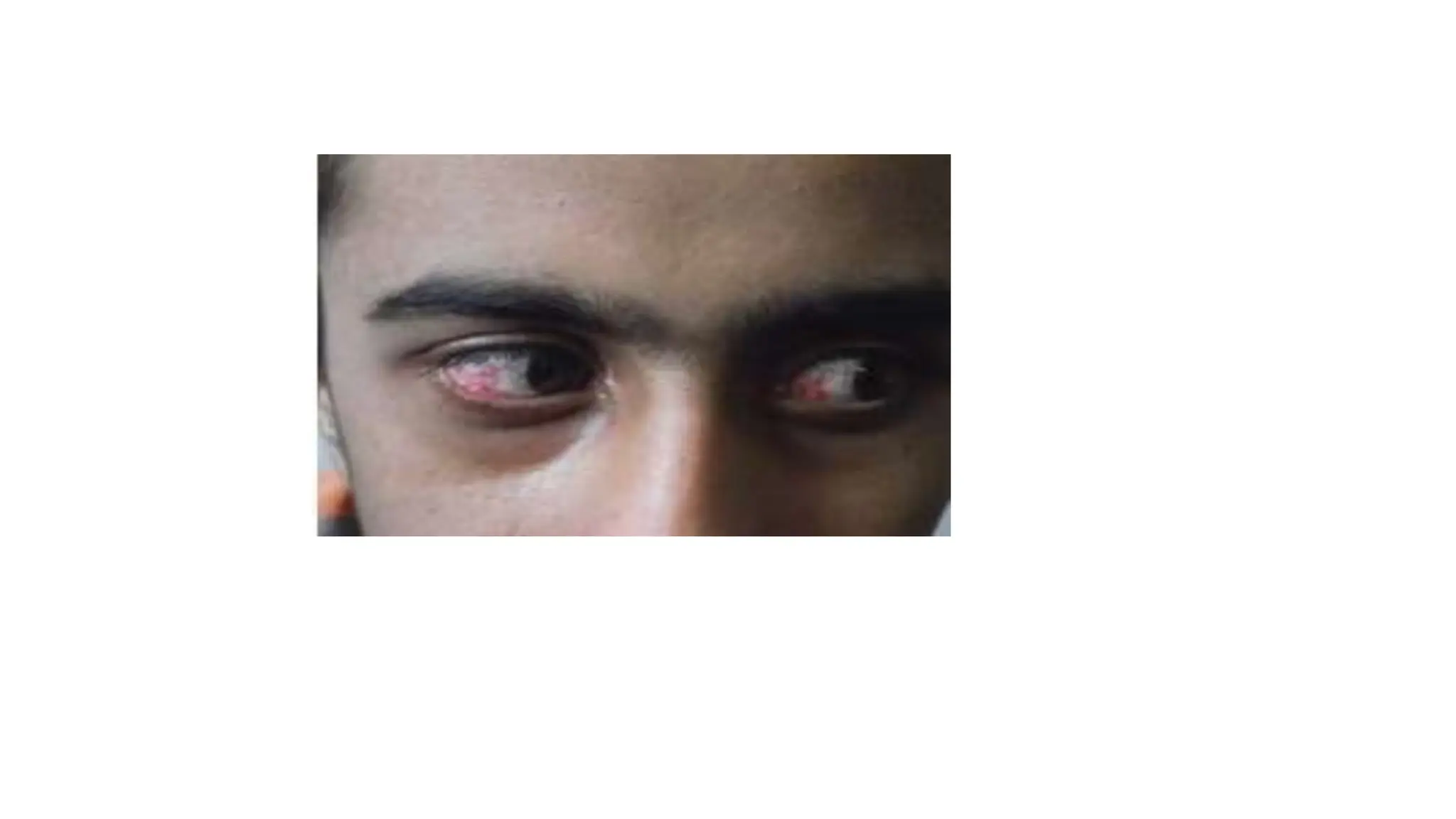 PREMATURE AGING SYNDROMES AND THEIR CLINICAL MANIFESTATIONS | PPTX