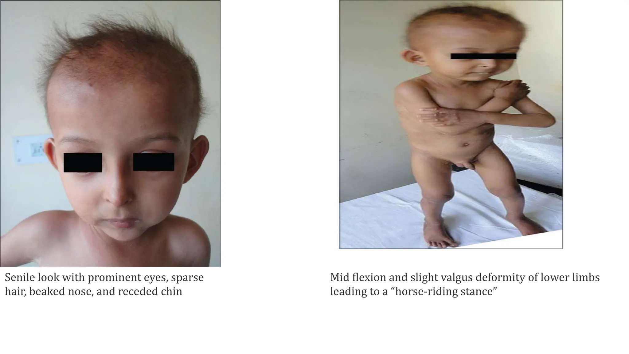 PREMATURE AGING SYNDROMES AND THEIR CLINICAL MANIFESTATIONS | PPT