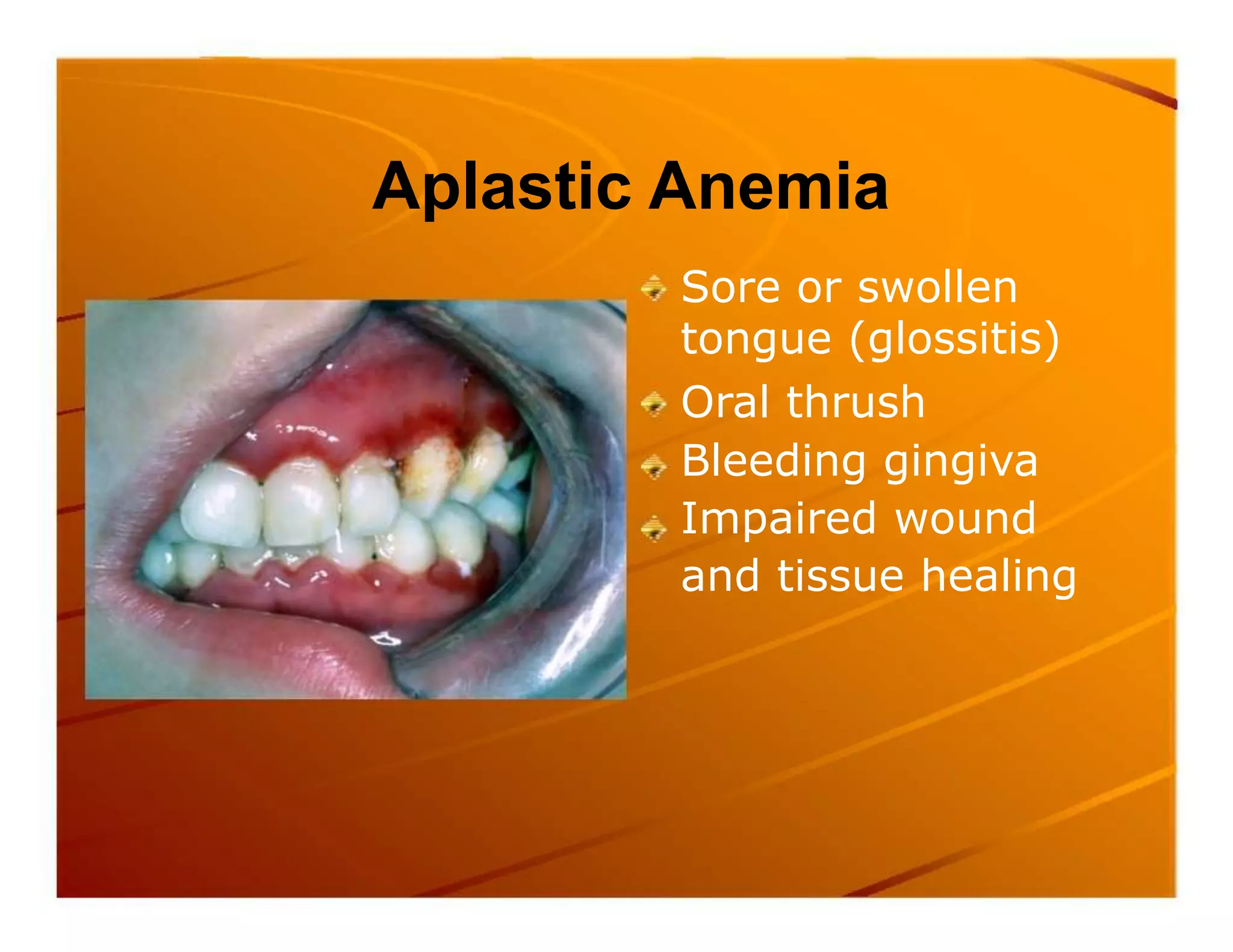 Premature exfoliation of primary teeth | PPTX