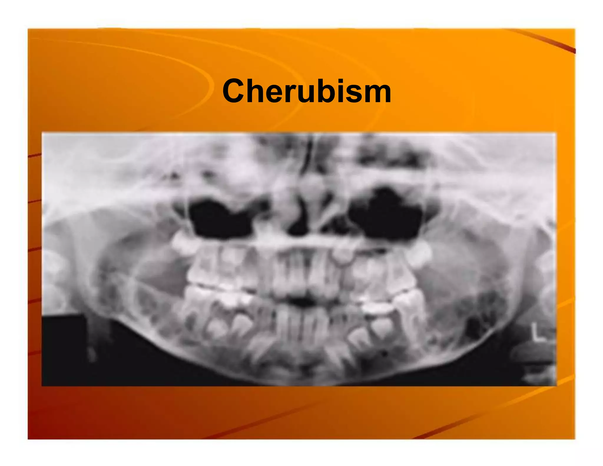 Premature exfoliation of primary teeth | PPTX