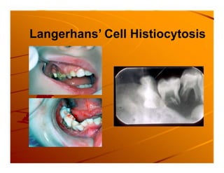 Premature exfoliation of primary teeth | PPTX