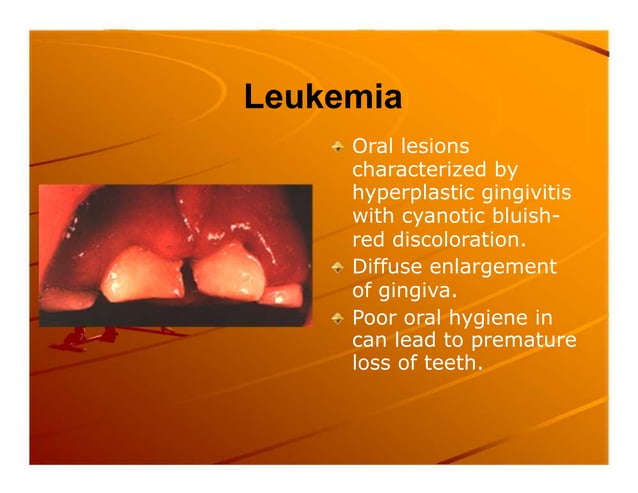 Premature exfoliation of primary teeth | PPTX