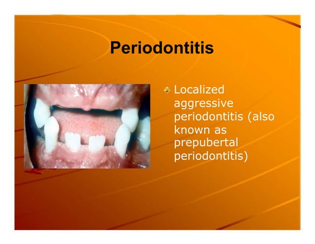 Premature exfoliation of primary teeth | PPT