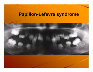 Premature exfoliation of primary teeth | PPTX