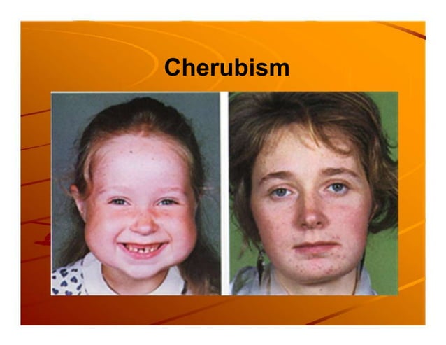 Premature exfoliation of primary teeth | PPTX