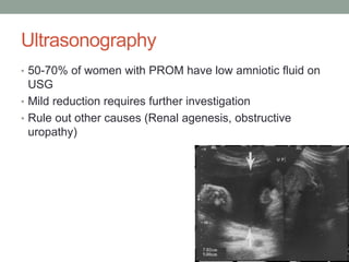 Premature rupture of membranes | PPTX
