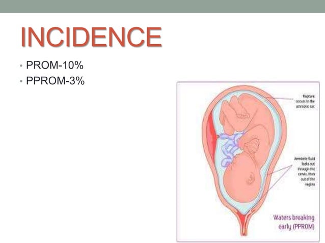Premature rupture of membranes | PPTX