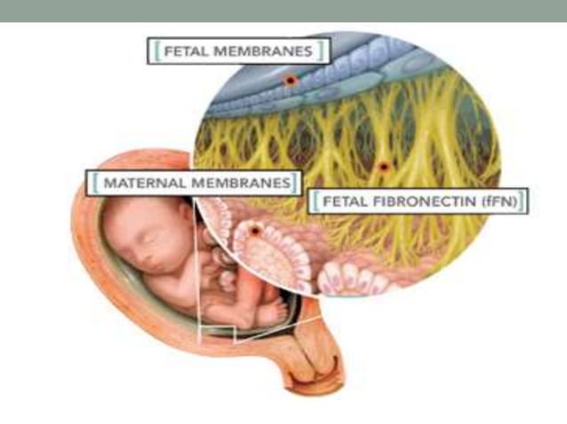Premature rupture of membranes