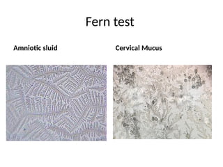 Premature Rupture of Membranes. - MBBS lecture pptx.pptx