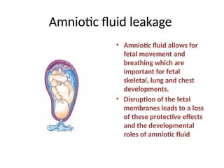 Premature Rupture of Membranes. - MBBS lecture pptx.pptx