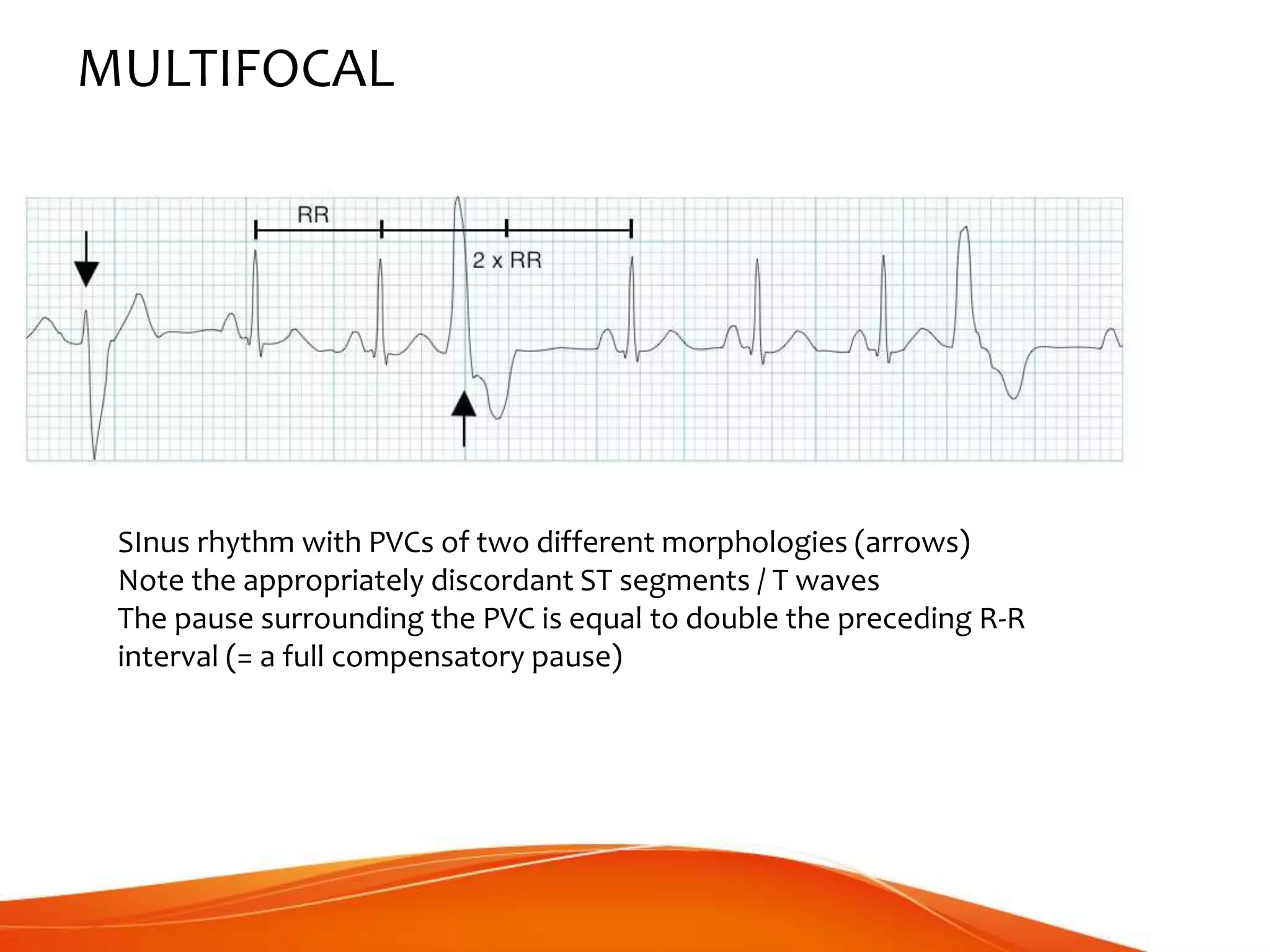 Pre mature ventricular complex | PPTX