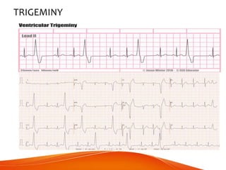 Pre mature ventricular complex | PPTX