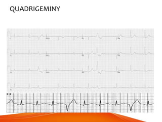 Pre mature ventricular complex | PPTX