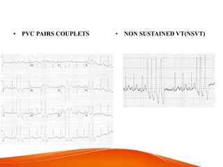 Pre mature ventricular complex | PPTX