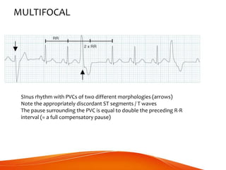 Pre mature ventricular complex | PPTX