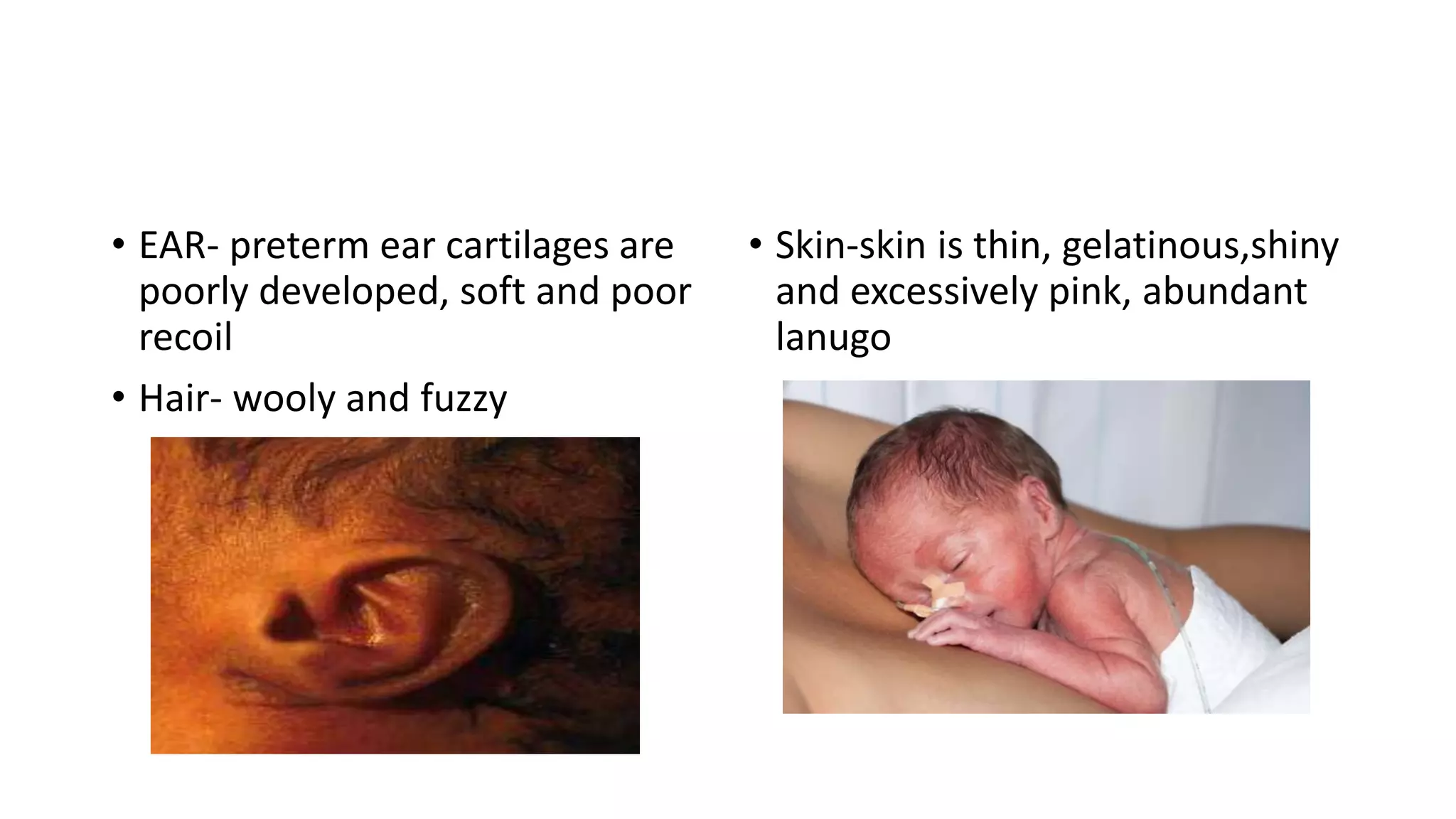 Prematurity | PPTX
