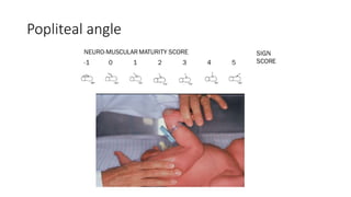 Prematurity | PPTX